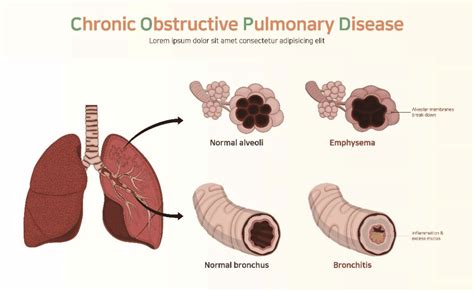 Chronic Obstructive Pulmonary Disease Copd In Singapore