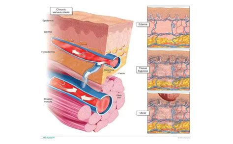 What Is A Chronic Leg Ulcer Venous Ulcers Are Ulcers With Venous