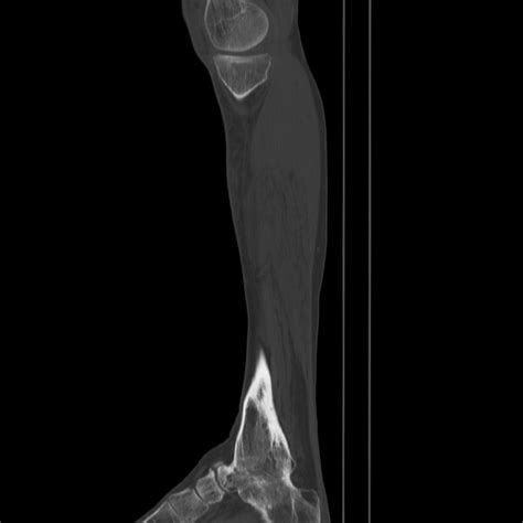 Brodie Abscess Tibia Radiopaedia 66028 75204 Sagittal Bone Window