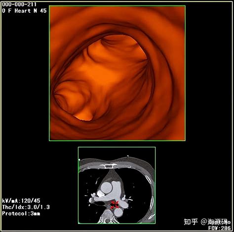 医院pacs系统源码 C S架构 带三维重建和还原 知乎