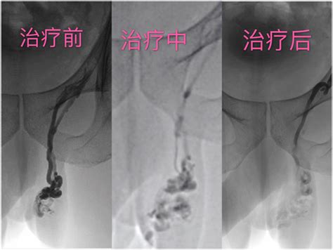 微创介入治疗精索静脉曲张解决“男”言之隐