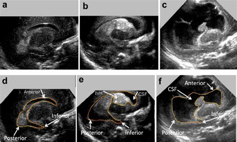 Two Dimensional Sagittal Views Of Three Preterm Neonates With Ivh In Download Scientific