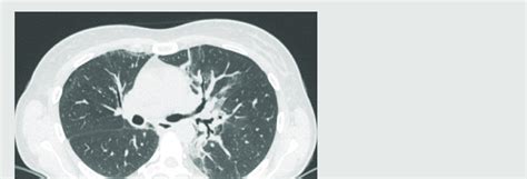 Ct Scan Transverse Section March 2017 Showing Bronchiectasis With