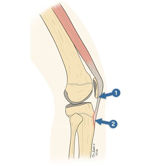 Patellar Tendonitis Pain Location And Quick Self Test