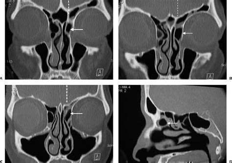 Anatomy Of The Frontal Recess And Frontal Sinus With Three Dimensional Reconstruction Ento Key
