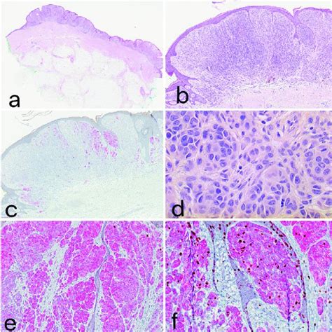 Pdf Nevoid Malignant Melanoma A Diagnosis Of A Nevus That You Later