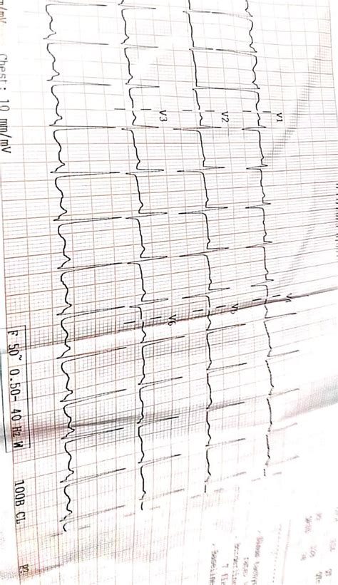 How Bad Does This Look Borderline Ecg Borderline T Abnormalities In