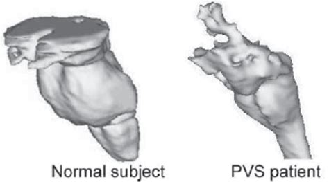 3d Anatomical Reconstruction Of Brainstems Of Normal Subject And A Pvs