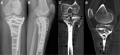 Medial Condyle Tibia Plating