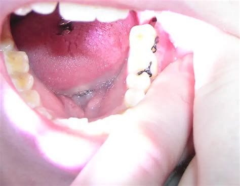 How To Heal Dry Socket After Wisdom Teeth Easy Guide