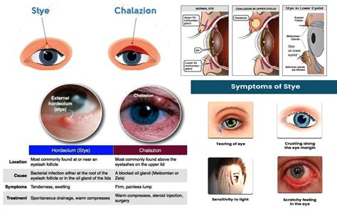 Stye Chalazion Causes Symptoms Stye Vs Chalazion Non Surgical Approach