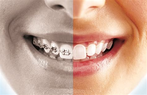 Clearpath Introduces 3d Aligners