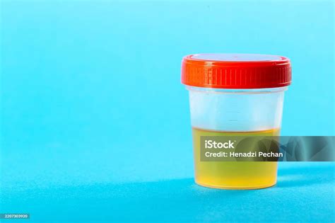 파란색 배경에 소변 테스트가 있는 의료 용기 신우신염 및 요로 세균에 대한 개념 소변 검사 텍스트를 위한 복사 공간 Escherichia Coli Pyelonephritis