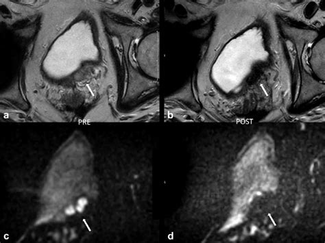Figure E2 Axial T2 Weighted A B And Diffusion Weighted C D Mr