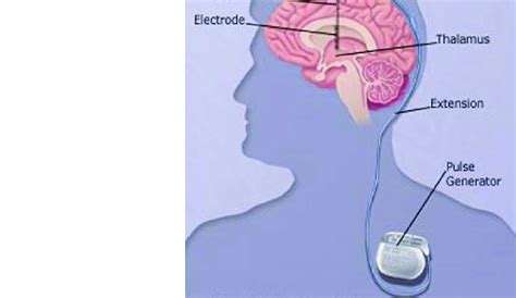 Implanted DBS Simulator 3 Download Scientific Diagram