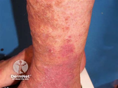 Dermatitis Leg Dermatitis