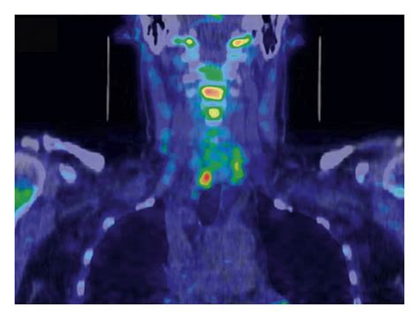 Persistent Hyperparathyroidism Preoperative ¹²³i 99mtc Subtraction Download Scientific Diagram