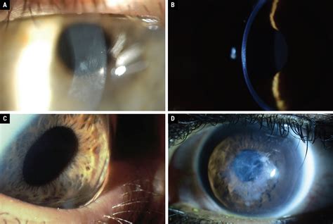 Decoding The Keratoconus Matrix