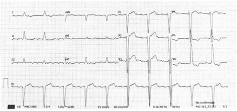 The Electrocardiography Showed Common Atrial Flutter Left Bundle