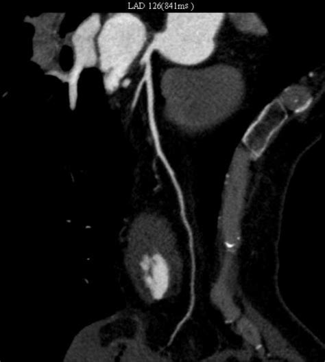 【期刊看点】延伸阅读｜家属陪同的模拟场景呼吸训练对冠状动脉ct血管造影检查的影响患者