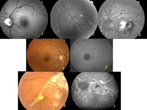 New Insights Into The Visual Prognosis Of Pseudoxanthoma Elasticum British Journal Of