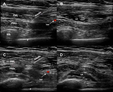Figure From Ultrasound Description Of Pecs Ii Modified Pecs 51 Off