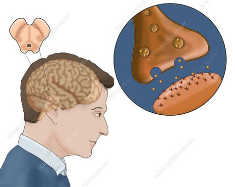 Parkinsons Disease And Dopamine At Beth Meeks Blog
