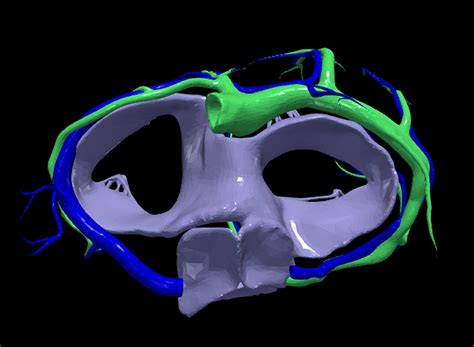 3d Model Of Common Arterial Trunk Truncus Arteriosus By Azekapeka