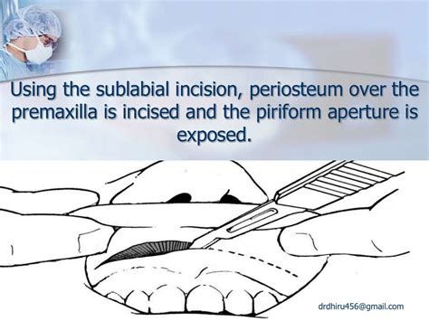 Transsphenoidal Hypophysectomy By Drdhiru456