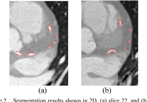 Figure 1 From A Fully Automated Framework For Segmentation And Stenosis