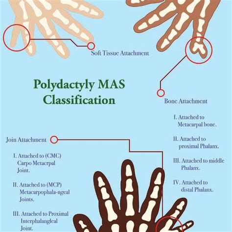 X Ray Showing Bilateral Ulnar Polydactyly Download Scientific Diagram