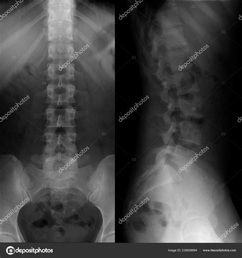 Lumbar Vertebrae X Ray