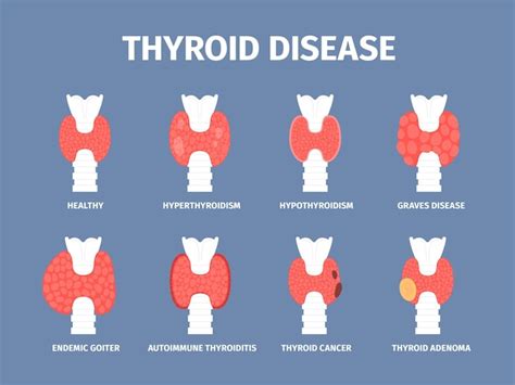 Premium Vector Thyroid Gland Various Diseases Goiter And Hyperthyroid
