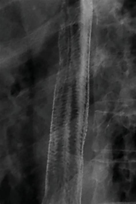 Pharynx And Esophagus Radiology Key Pharynx And Esophagus Radiology Key
