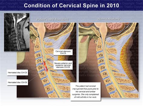Pre Operative Condition Of Cervical Spine