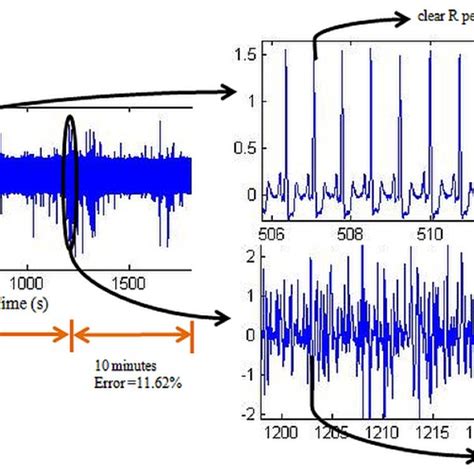 Factors Affecting Accuracy Of QRS Detection In Record 105 Download Scientific Diagram