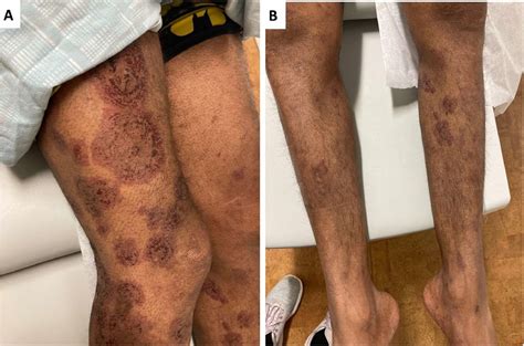 Leukocytoclastic Vasculitis In Association With Linear Epidermal