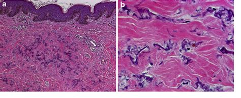 Figure 2 From A Forensic Autopsy Case Of Death In A Patient With Pseudoxanthoma Elasticum