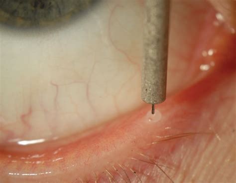 Punctal Occlusion Doesnt Worsen Ocular Allergy Symptoms