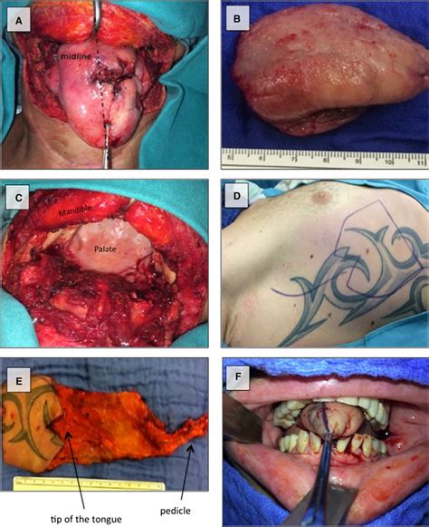 Total Glossectomy Via Transcervical Approach And Reconstruction A