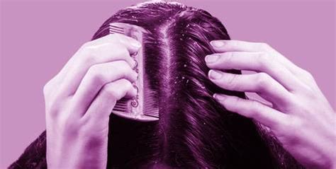 How To Remove All Dandruff From Hair