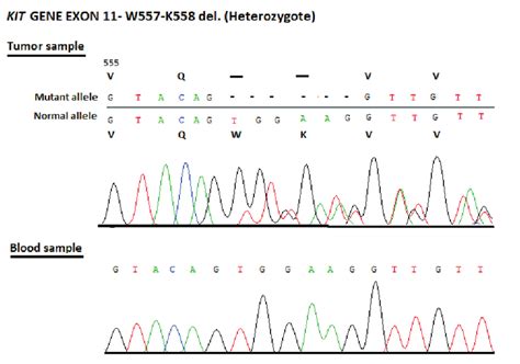 Kit Gene Exon 11 W557 K558 Deletion Heterozygote The Most Common