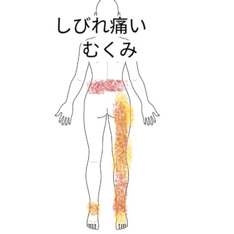 常にお尻から足までシビレて足がこわばる腰痛｜脚・足・足指のしびれ、腰痛のツボ｜ツボネット 鍼灸の症例が検索できるツボ辞典