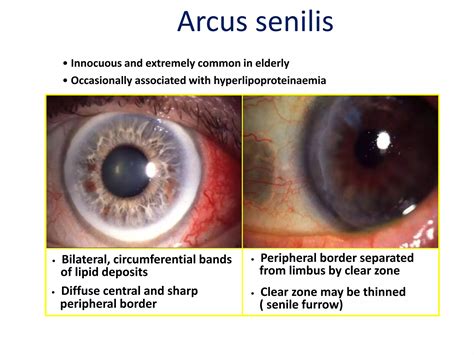 Corneal Degenerations Dr Arnav Saroya Pptx