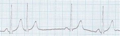 Atrial And Ventricular Ectopy