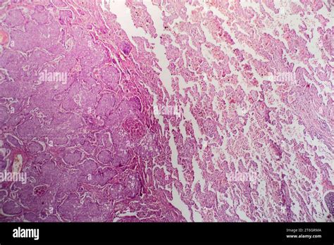 Photomicrograph Of Lung Adenocarcinoma Illustrating Malignant Glandular Cells Characteristic Of