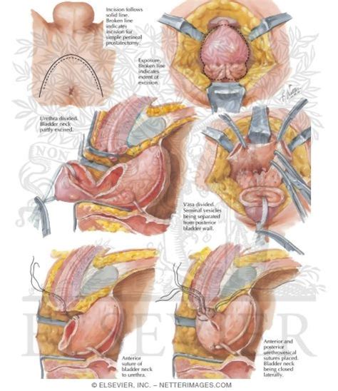 Radical Prostatectomy