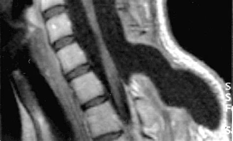 Postoperative Gadolinium Enhanced Mri Showing Complete Excision Of The