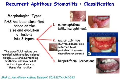 Recurrent Aphthous Stomatitis Ppt