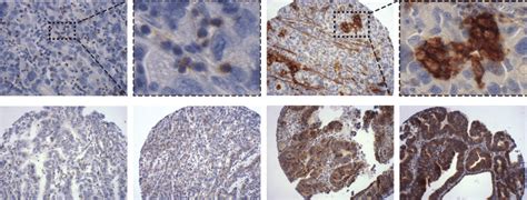 Ihc Staining Of Ffpe Esophageal Tissues In Tissue Microarrays Â20 Download Scientific